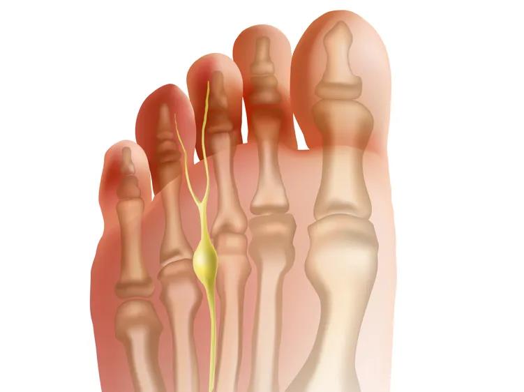 Neuromas Treatment in Fort Mill, SC